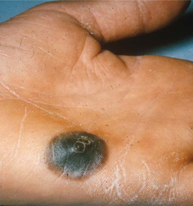 Anthrax back in France: Should we be worried about it in the CBRN ...